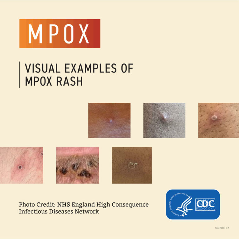 Mpox - Hamilton County Public Health